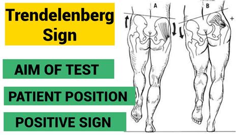 Trendelenburg Bedeutung Trendelenburg Hinken Behandlung Dkuzs