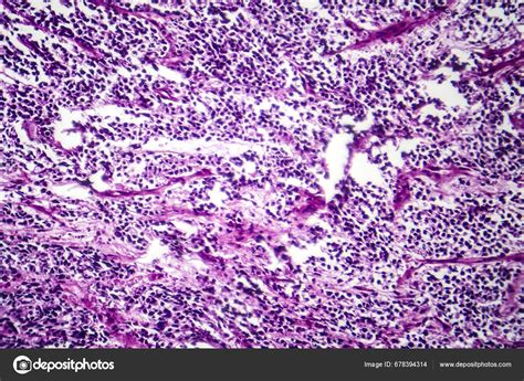 Photomicrograph Small Cell Lung Cancer Revealing Densely Packed