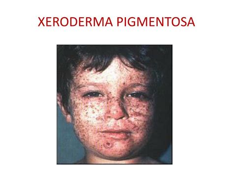 Ppt Skin Tumours Powerpoint Presentation Free Download Id2354904 Ppt Skin Tumours Powerpoint Presentation Free Download Id2354904