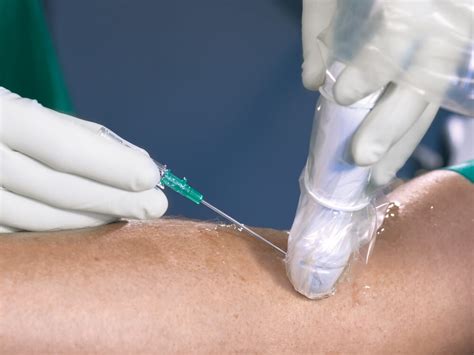 Ultrasound Guided Long Peripheral IV Catheter USG Long PIVC B Braun