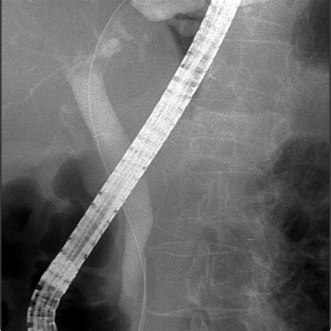Fluoroscopy Image Of The Direct Peroral Cholangioscopy With An