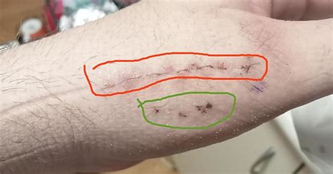 Pro Tip To Anyone Who Breaks The Metacarpal Bone In Their Thumb Keep It Still When The K