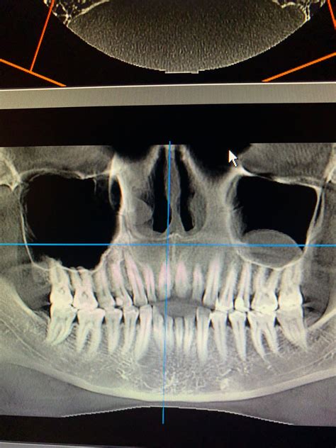 Что это в гайморовой пазухе Портал радиологов