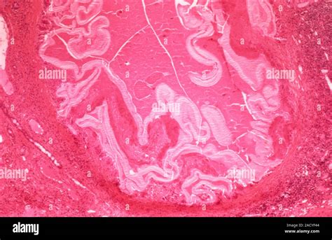 Tapeworm Infested Liver Light Micrograph Of A Section Through Cysts In