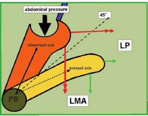 Abnormal Vertical Axis Due To Promontorium Fixation Blue In Case Of Download Scientific