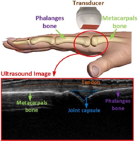 Figure 1 From Segmentation Of Bones And Mcp Joint Region Of The Hand From Ultrasound Images