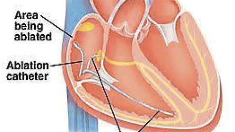 Atrial Flutter Ablation Procedure Atrial Flutter Ablation Procedure