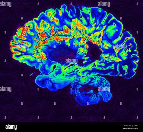 This Is A Pseudo Colored Image Of A High Resolution Gradient Echo Mri