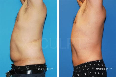 Tummy Tuck For Men Photos Xsculpt