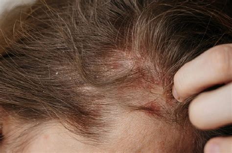 Understanding The Condition Scalp Dermatitis Pradhanclinic