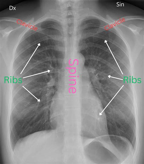 Normal Vs Abnormal Chest X Rays What Do They Reveal