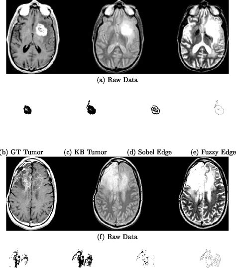 Figure 112 From Unsupervised Brain Tumor Segmentation Using Knowledge