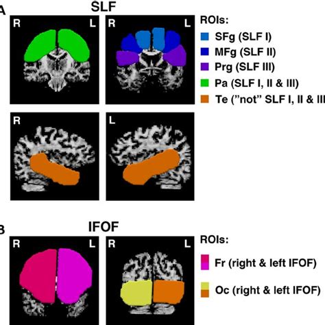 Examples Of Spherical Deconvolution Tractography Reconstruction Of The