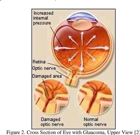 Figure 1 From A Review Of Automated Diagnosis Of Glaucoma Using Digital Fundus Images Semantic