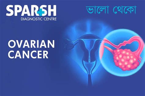 Ovarian Cancer The Silent Killer Sparsh Diagnostic Center
