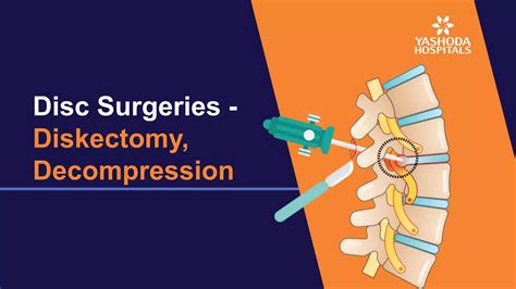 Spine Disc Surgeries Discectomy And Decompression Pptx