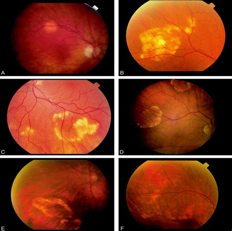 Cme Review Sclerochoroidal Calcification The 2001 Harold G Retina