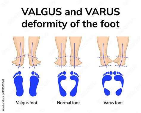 Valgus Feet Exercises At Toby Denison Blog