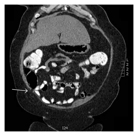 Ct Findings Of The Subcutaneous Vermiform Appendix A Arrow Download Scientific Diagram