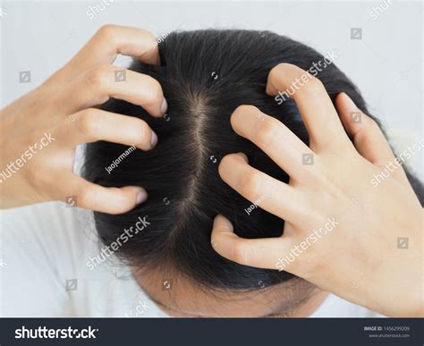 Scalp Allergy Images Stock Photos Vectors Shutterstock