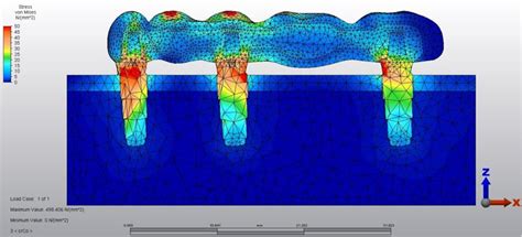 Figure 2 From A Three Dimensional Finite Element Analysis Of Stress Distribution In Inclined