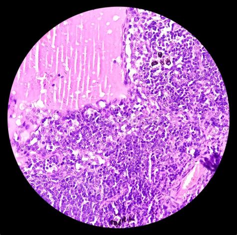Thyroid Cancer Tracheal Gland Involved By Tumor Metastatic Papillary Carcinoma Of Thyroid