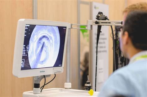 李胜龙 On Linkedin Sonoscape Endoscopy System In Ueg