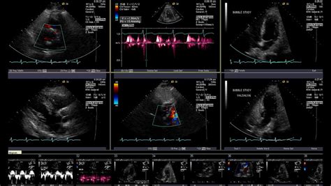 Echocardiogram Stock Video Footage 4k And Hd Video Clips Shutterstock