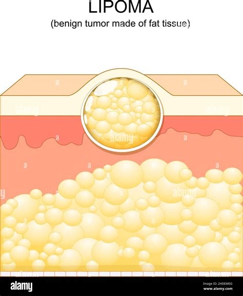 Subcutaneous Layer
