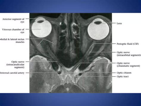 Orbit Imaging Anatomy Pptx