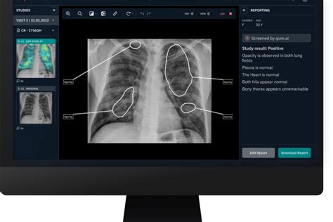 Nhsggc Trials Ai Powered X Rays In Fight Against Lung Cancer Nhsggc