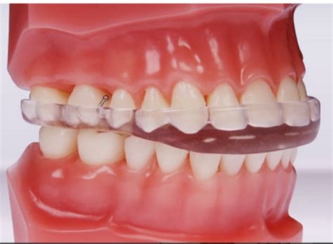 Occlusal Splints Trs Dental Lab Limerick Digital Dental Lab