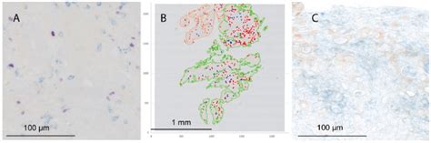 Evaluation Of Foxp3 And Cd8 Tumour Infiltrating Cells And Pd 1 And