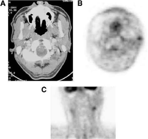 Imaging Findings Of 65 Y Old Man With Slow Growing Mass In Left