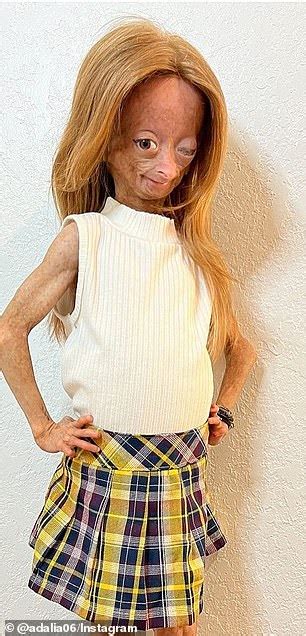 Youtube Star Who Battled Real Life Benjamin Button Disease Dies At The