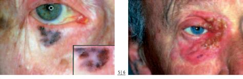 Palpebral Branch Of Infratrochlear Nerve Semantic Scholar