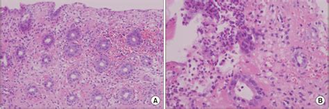 Hande Stained Biopsy Specimens From The Ascending Colon Of The Patient 2
