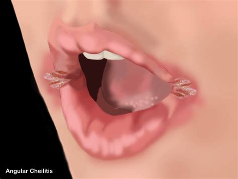 How Angular Cheilitis Progress And Is It Contagious How Angular Cheilitis Progress And Is It Contagious