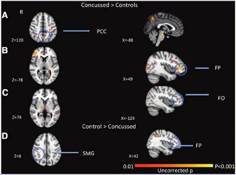 Differences In Resting State Networks Between The Control Adolescent