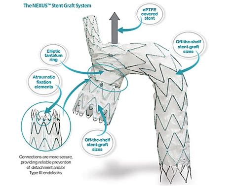 Jayaprabu Premkumar On Linkedin Nexus® Aortic Arch Stent Graft System