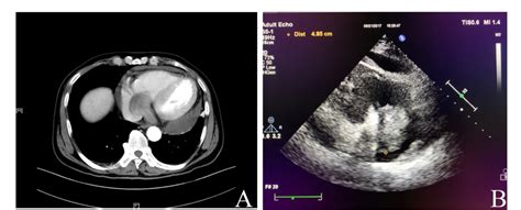 Figure 1 From Malignant Gastrointestinal Neuroectodermal Tumor In The Right Heart A Report Of