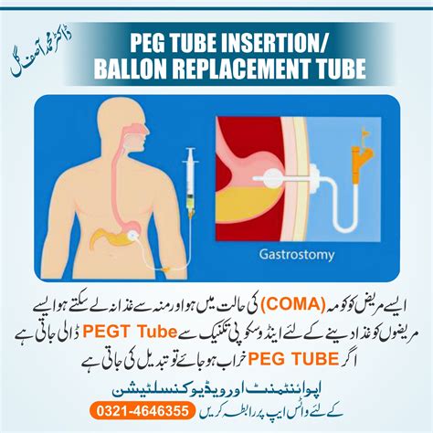peg tube insertion drmasifgul