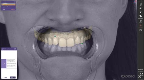 Smile Creator Exocad