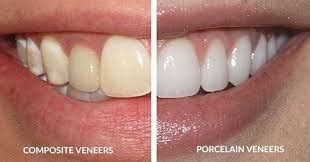 Transform Your Smile A Comprehensive Guide To Composite And Porcelain