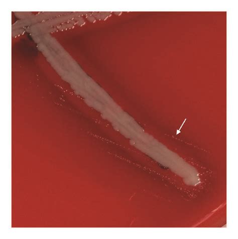 Satellite Growth Of Nutritional Variant Streptococci Nvs Around