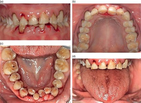 Thrombocytopenia Pocket Dentistry
