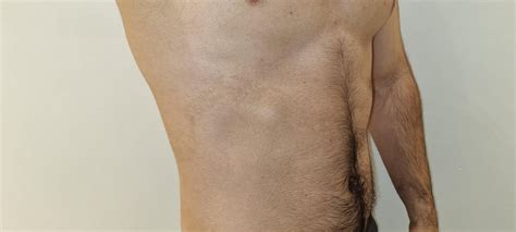 Hyperpigmented Lesion Rdermatologyquestions