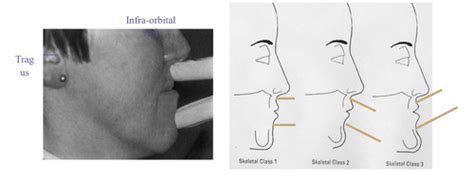 Orthodontic Classification Terminology And Iotn Flashcards Quizlet
