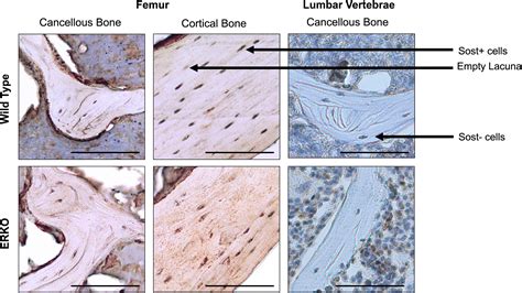 Cancellous Vs Cortical Bone