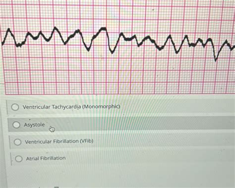 Ventricular Tachycardia Monomorphic Asystole Ventricular Fibrillation Vfib Atrial Fibrillation